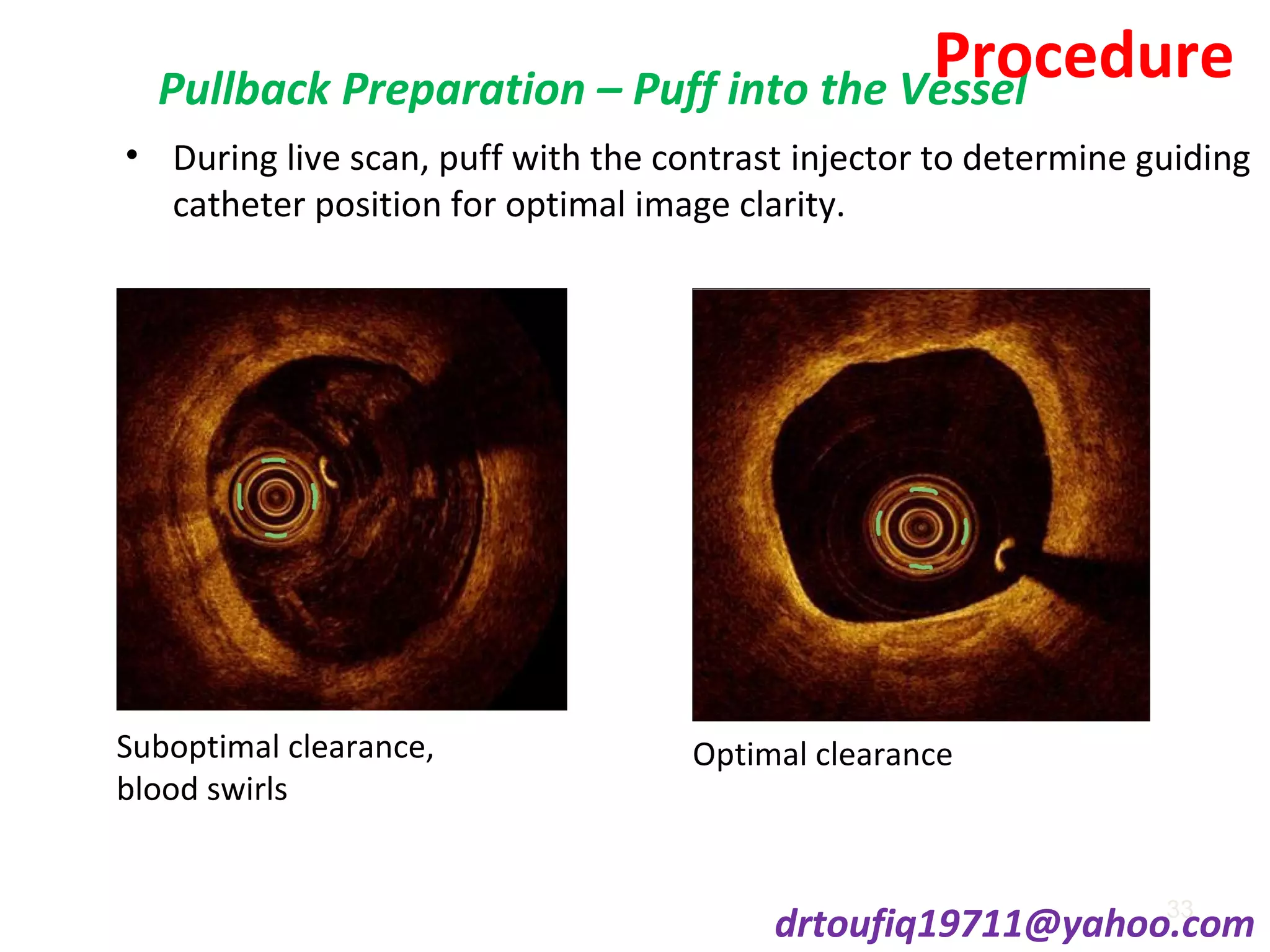 Optical Coherence Tomography dr md toufiqur rahman cardiologist | PPT