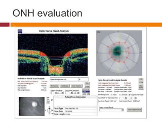 OCT in Ophthalmology | PPTX