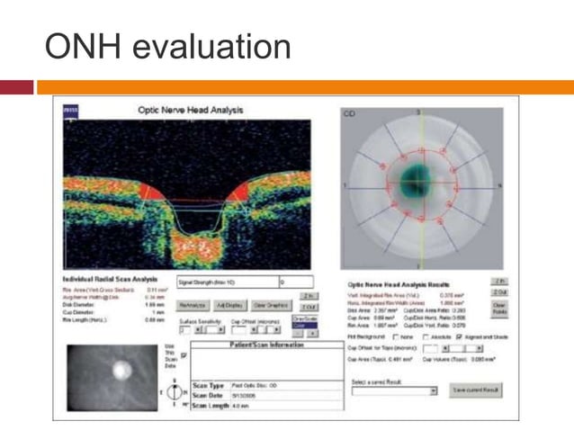 OCT in Ophthalmology | PPTX