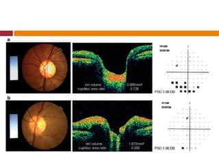OCT in Ophthalmology | PPTX