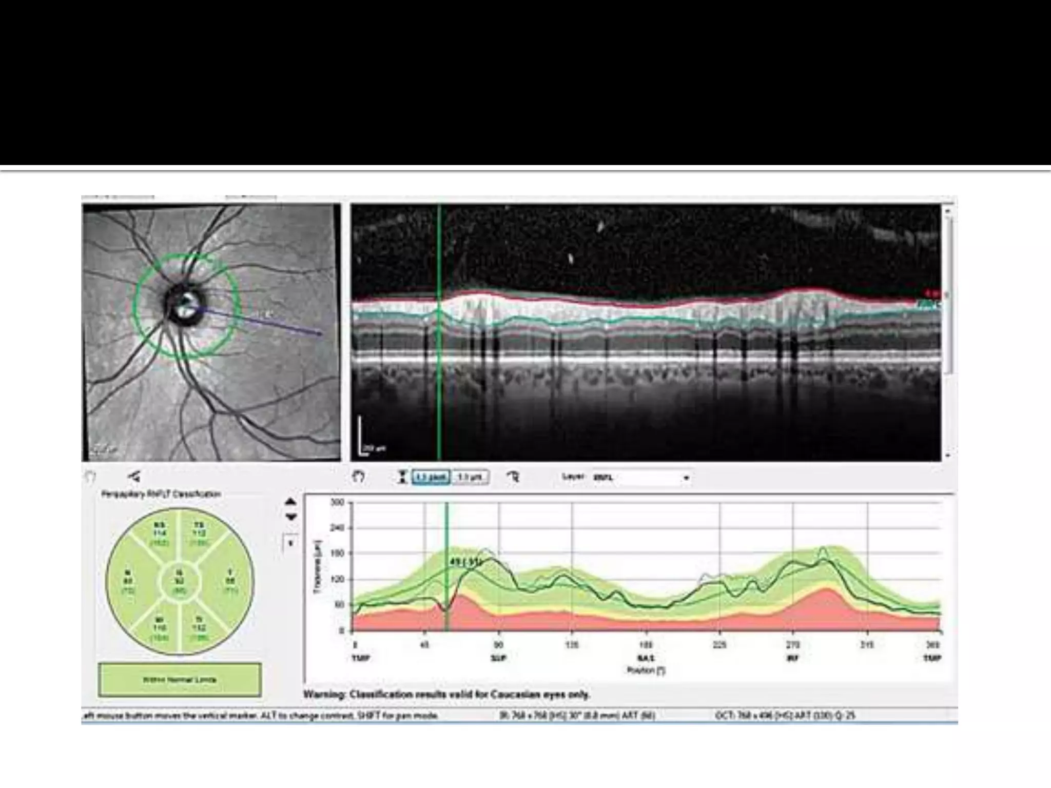 Optical Coherence Tomography (OCT) | PPTX