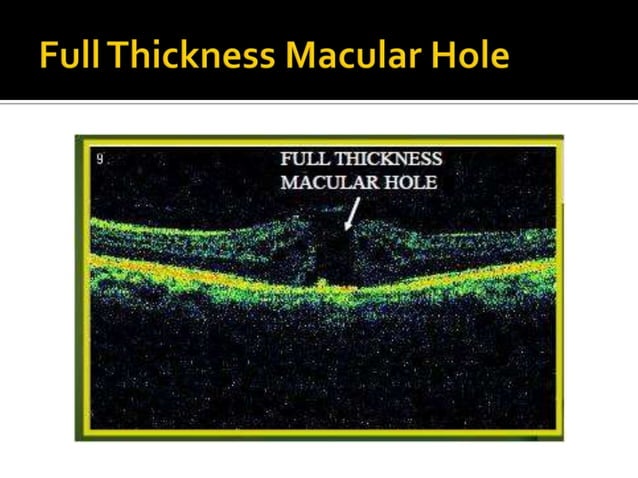 Optical Coherence Tomography (OCT) | PPTX | Physics | Science