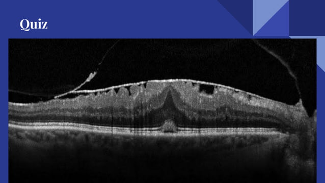 Optical coherence tomography in Ophthalmology.pptx