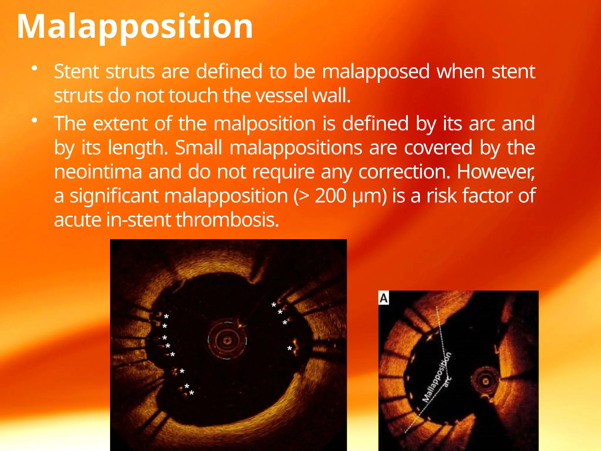 OCT in intervention cardiology managment.pptx