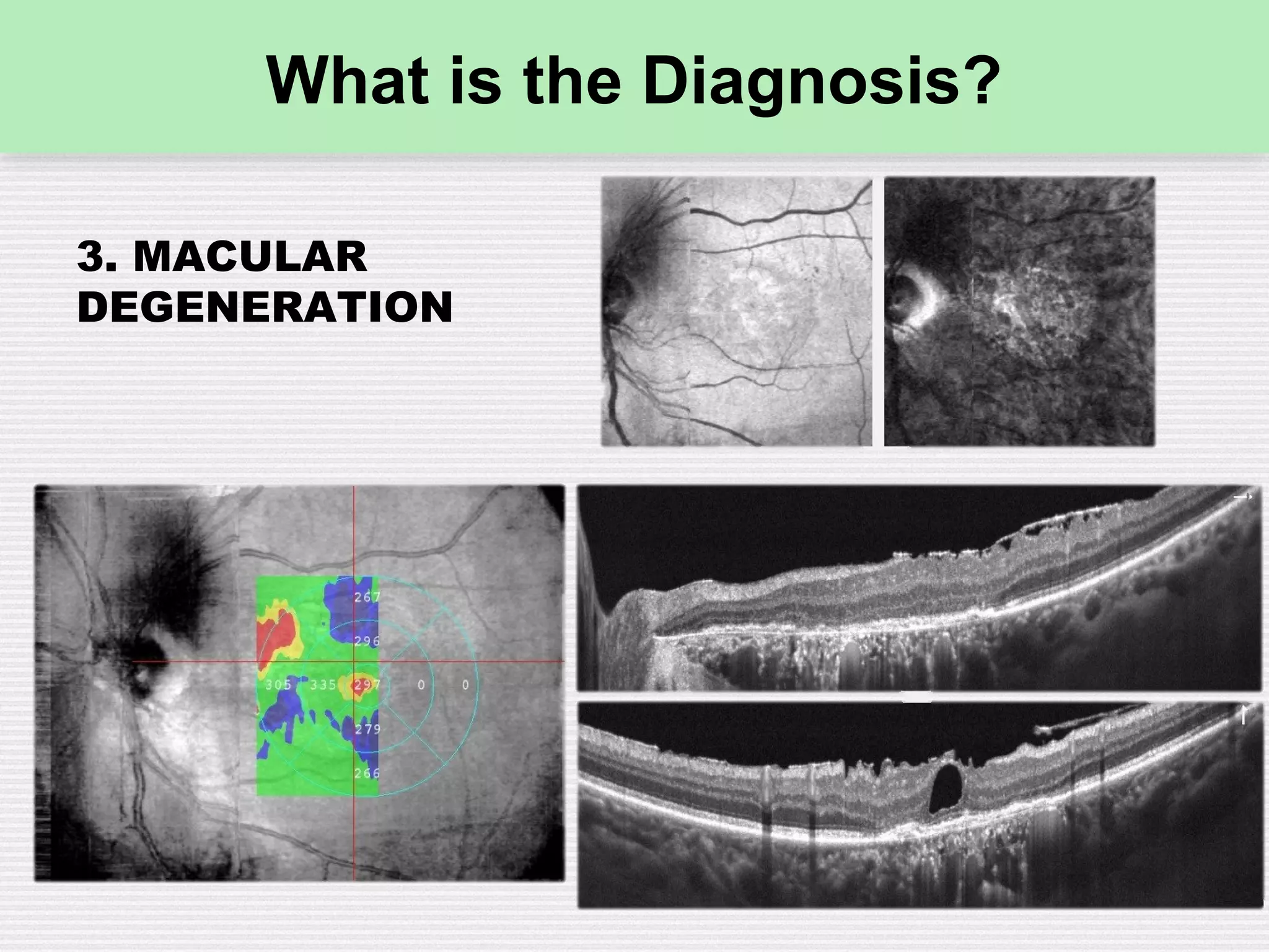OCTA Optical Coherence Tomography angiography | PPS