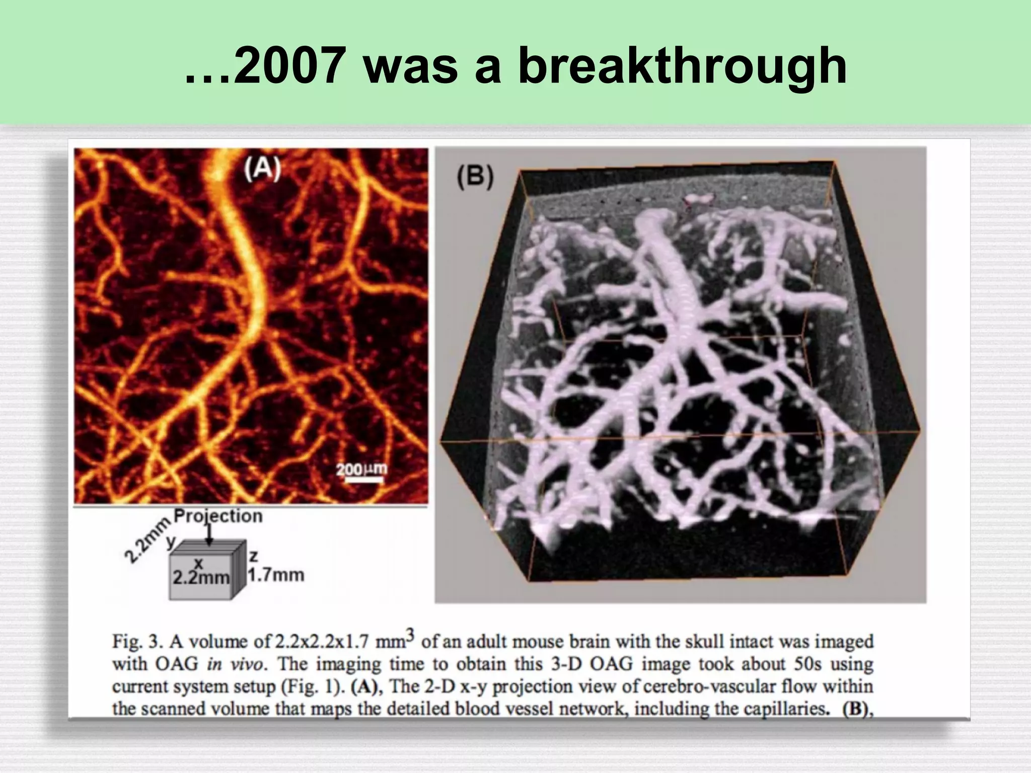 OCTA Optical Coherence Tomography angiography | PPS