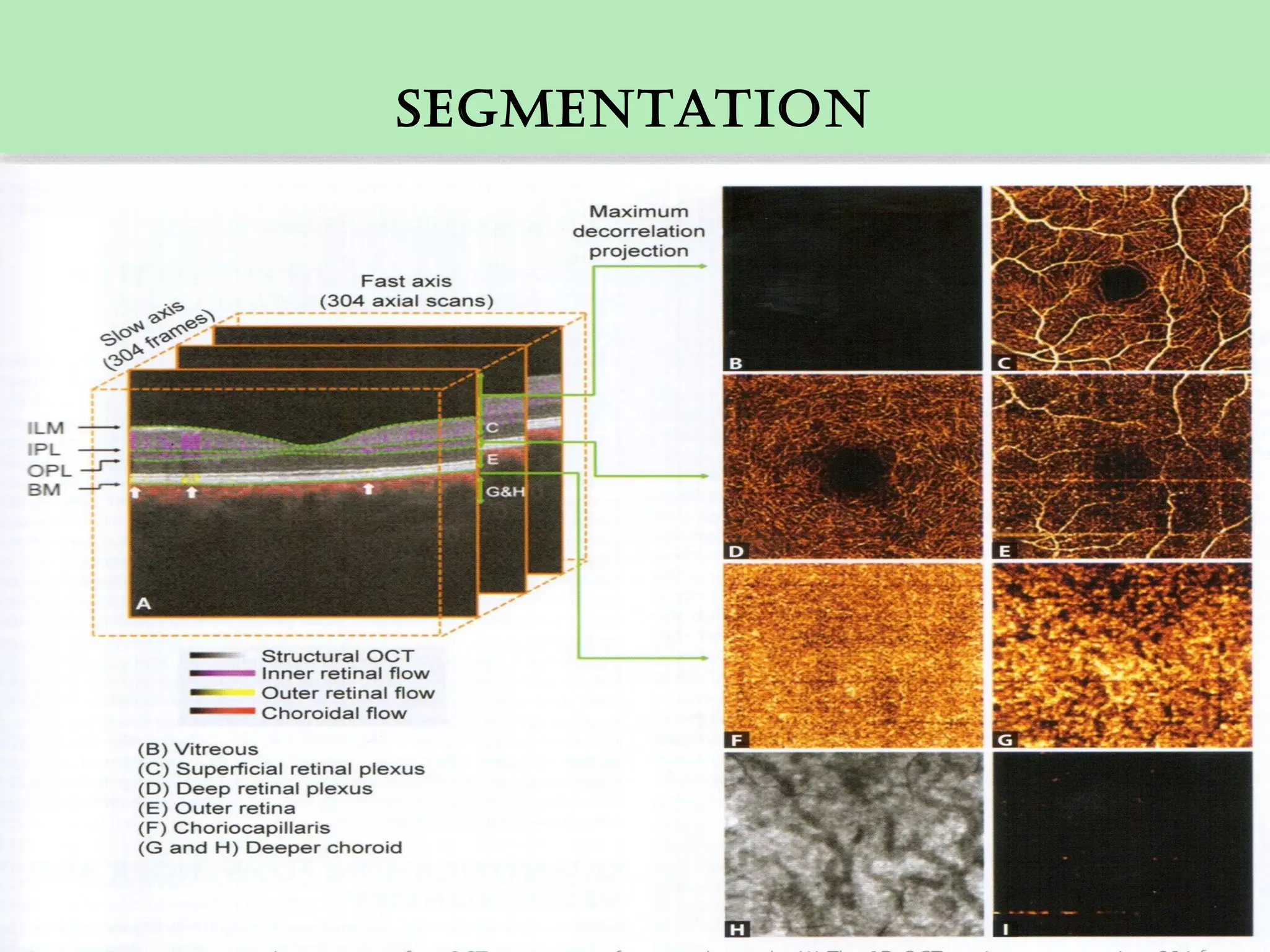 OCTA Optical Coherence Tomography angiography | PPS