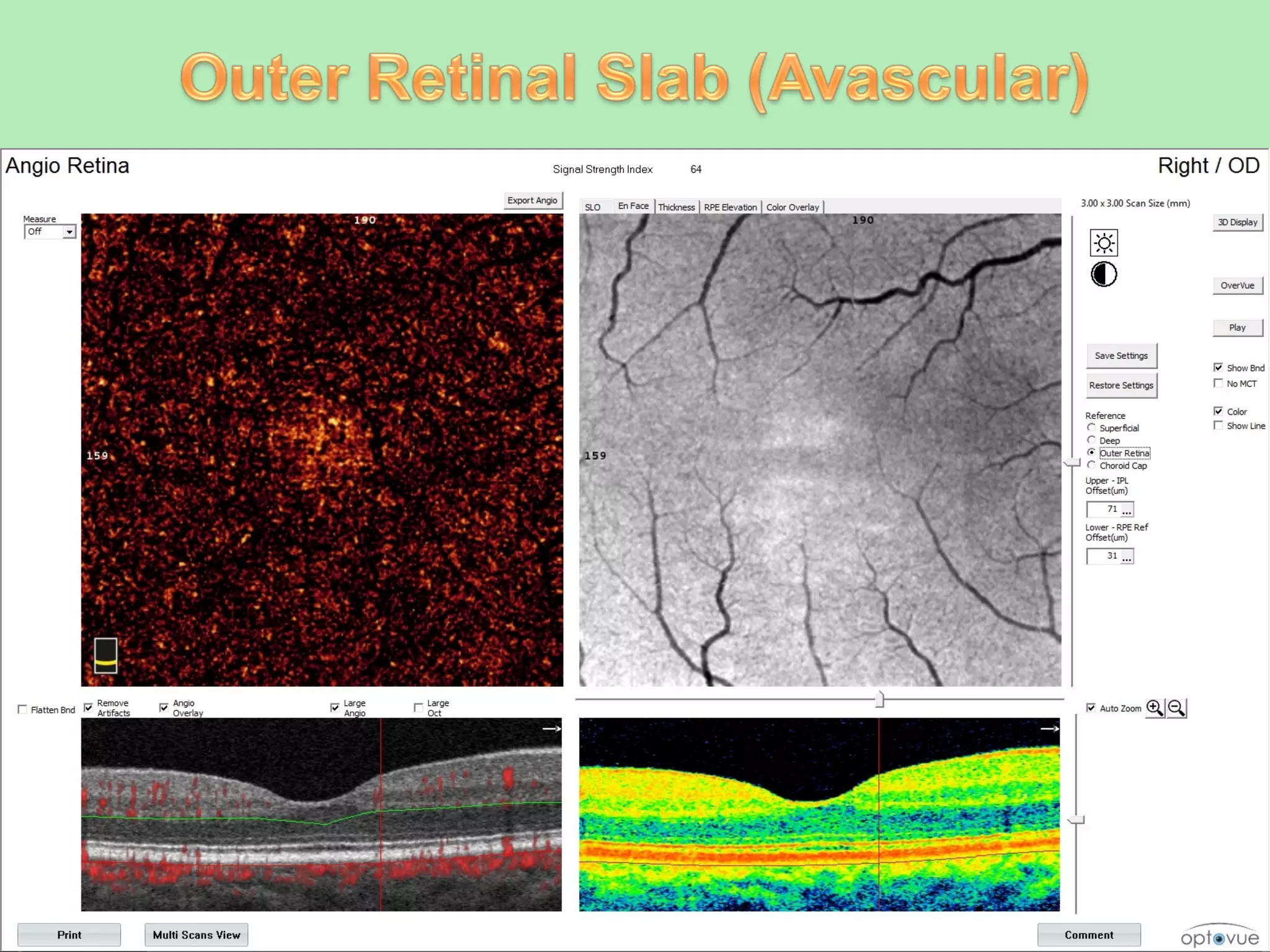 OCTA Optical Coherence Tomography angiography | PPS