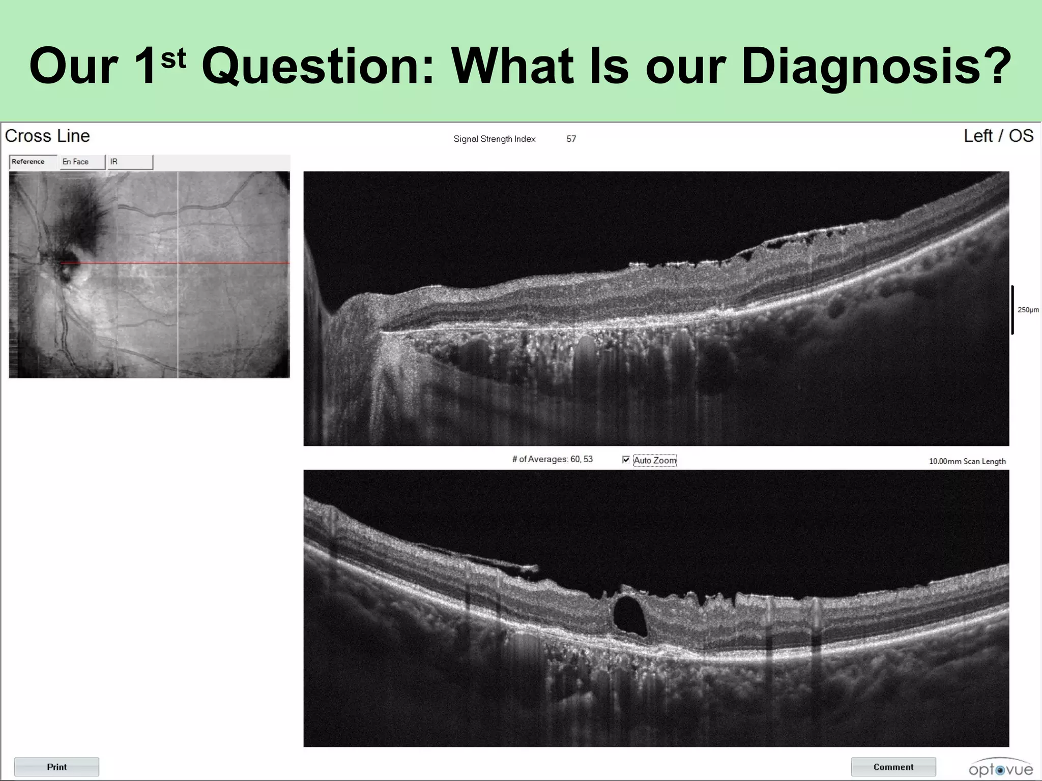 OCTA Optical Coherence Tomography angiography | PPS