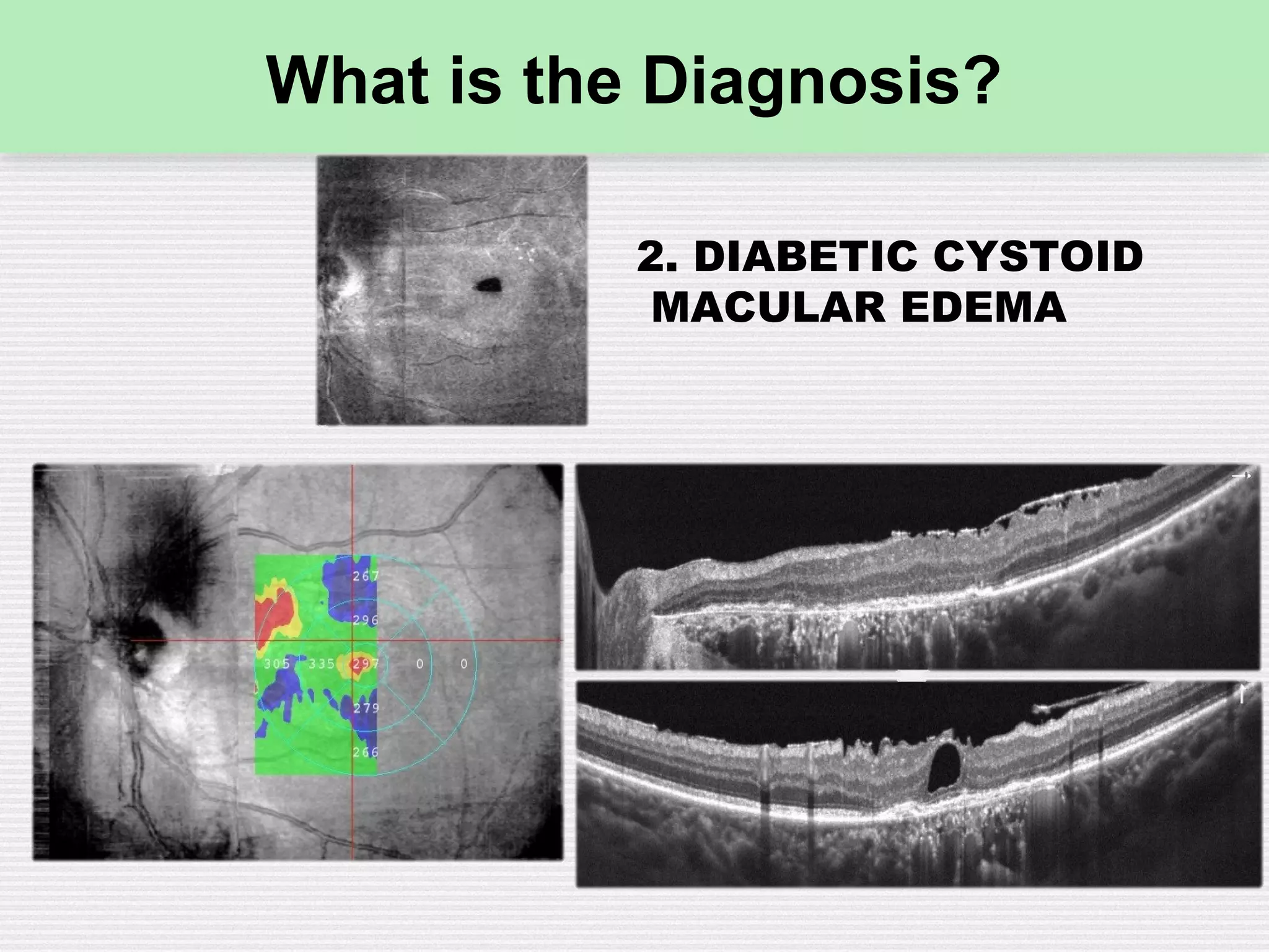 OCTA Optical Coherence Tomography angiography | PPS