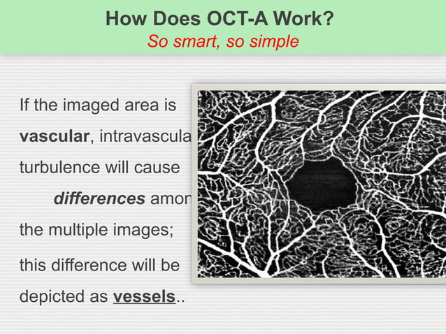 OCTA Optical Coherence Tomography angiography | PPS