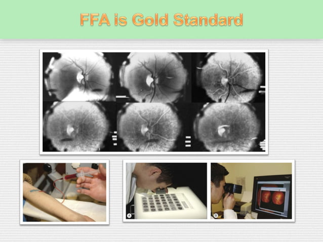 OCTA Optical Coherence Tomography angiography | PPS