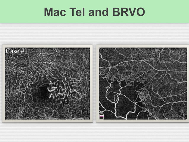OCTA Optical Coherence Tomography angiography | PPS
