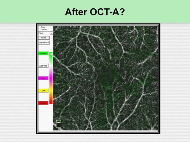 OCTA Optical Coherence Tomography angiography | PPS