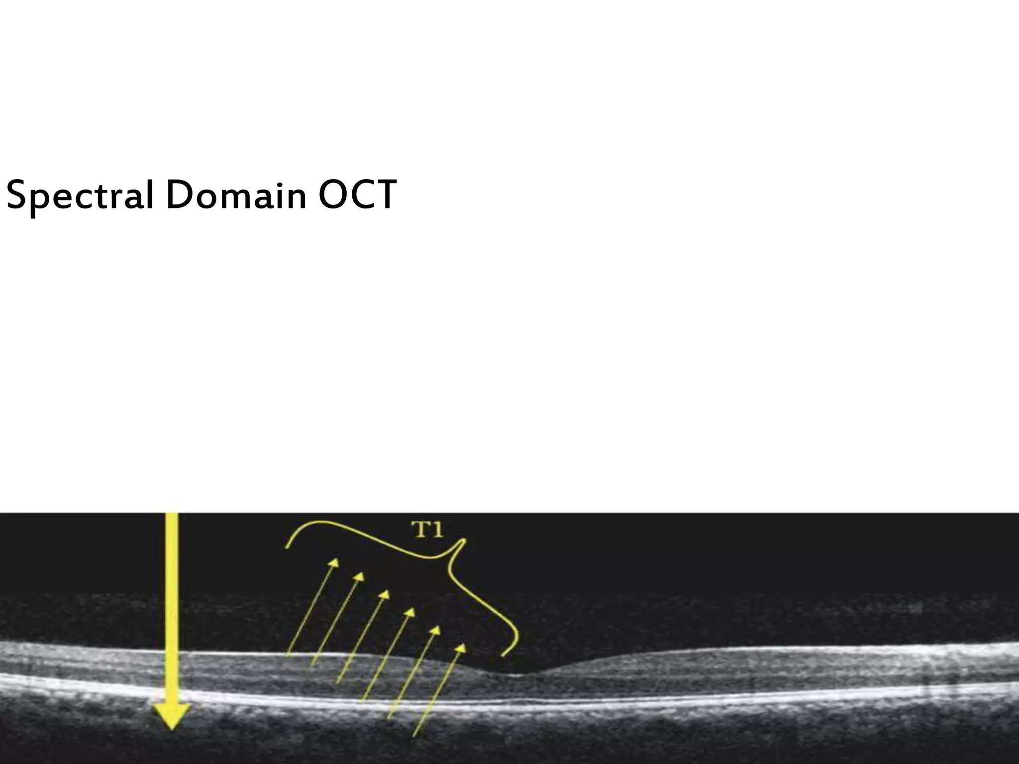 Optical coherence tomography(OCT) --macula | PPTX | Eye and Vision ...
