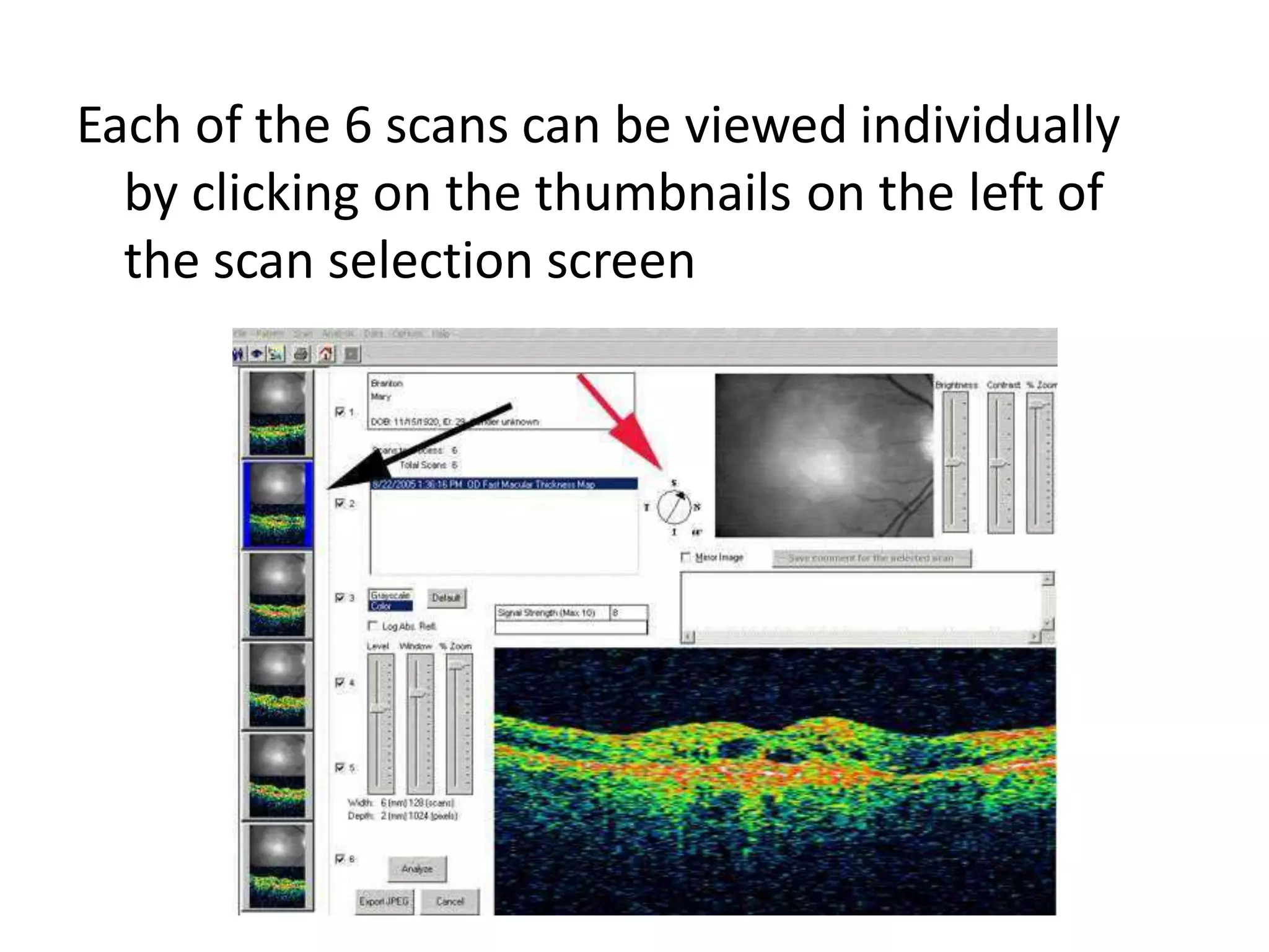 Optical coherence tomography(OCT) --macula | PPTX