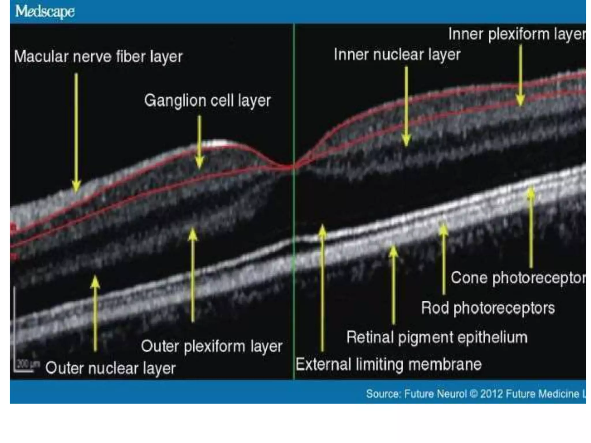 Optical coherence tomography(OCT) --macula | PPTX