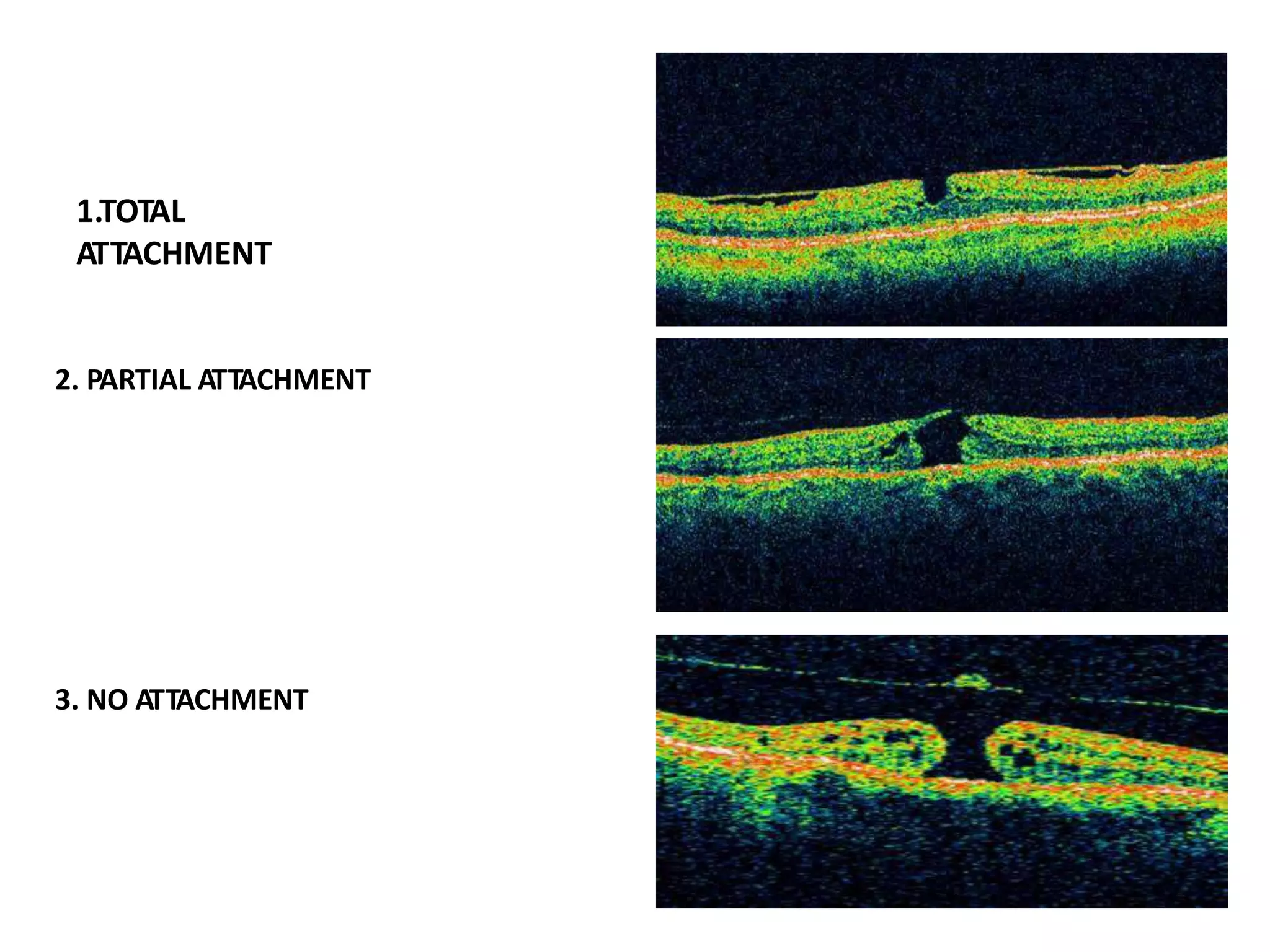 Optical coherence tomography(OCT) --macula | PPTX