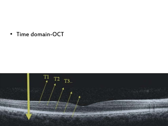 Optical coherence tomography(OCT) --macula | PPTX | Eye and Vision Conditions | Diseases and ...