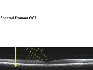 Optical coherence tomography(OCT) --macula | PPTX