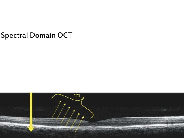 Optical coherence tomography(OCT) --macula | PPTX | Eye and Vision ...