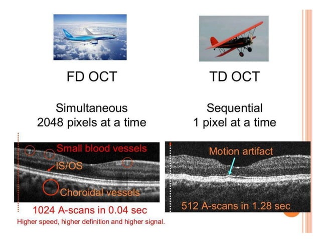 Optical coherence tomography(OCT) --macula | PPTX | Eye and Vision ...