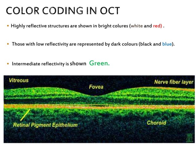 Optical coherence tomography(OCT) --macula | PPTX | Eye and Vision ...