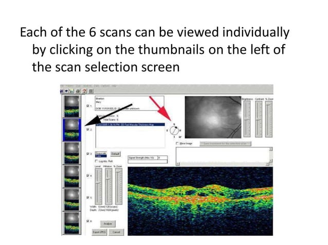 Optical coherence tomography(OCT) --macula | PPTX | Eye and Vision ...