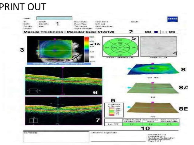 Optical coherence tomography(OCT) --macula | PPTX | Eye and Vision ...