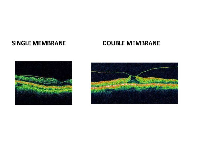 Optical coherence tomography(OCT) --macula | PPTX | Eye and Vision ...