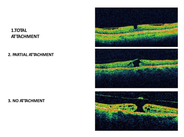 Optical coherence tomography(OCT) --macula | PPTX | Eye and Vision ...