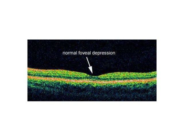 Optical coherence tomography(OCT) --macula | PPTX | Eye and Vision ...