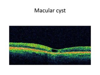 Optical coherence tomography(OCT) --macula | PPTX