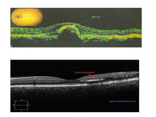 Optical coherence tomography(OCT) --macula | PPTX