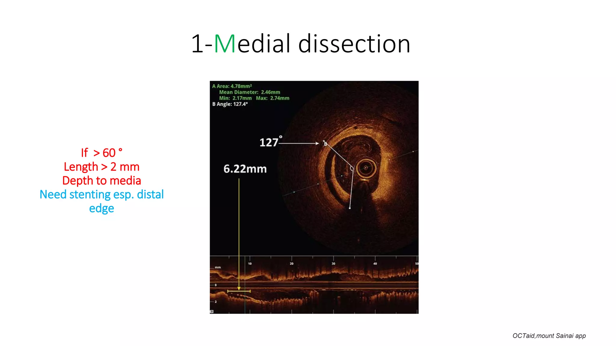 OCT in coronary PCI | PDF