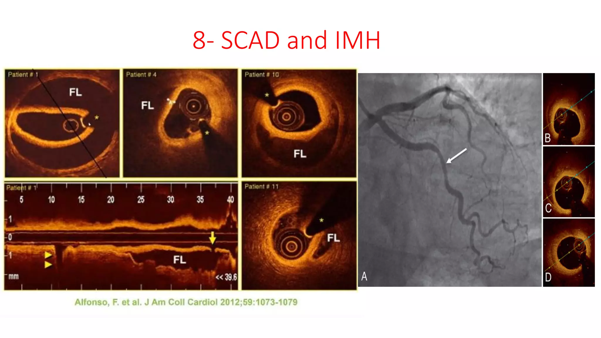 OCT in coronary PCI | PDF