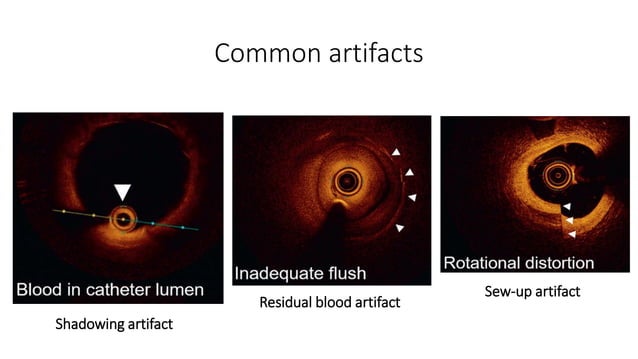 OCT in coronary PCI | PDF
