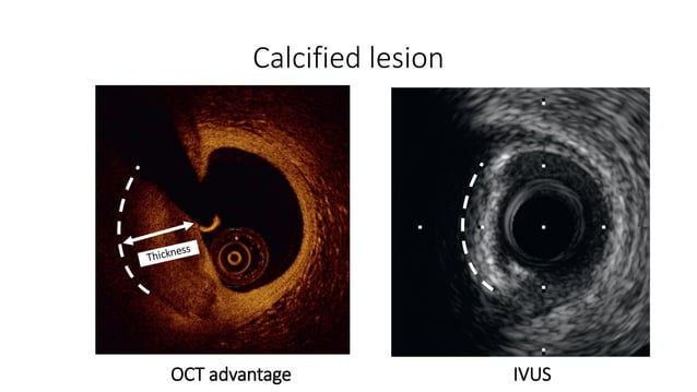 OCT in coronary PCI | PDF