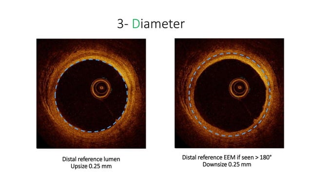 OCT in coronary PCI | PDF