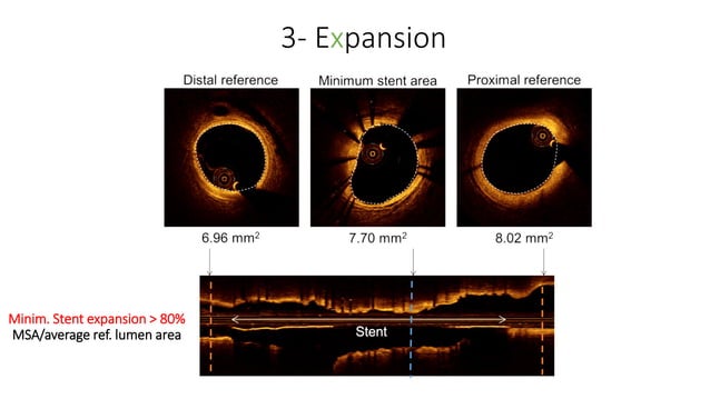 OCT in coronary PCI | PDF