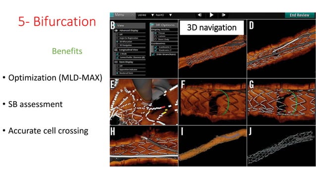 OCT in coronary PCI | PDF