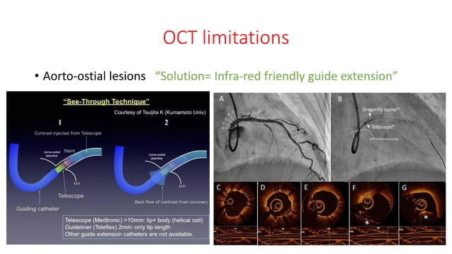 OCT in coronary PCI | PDF