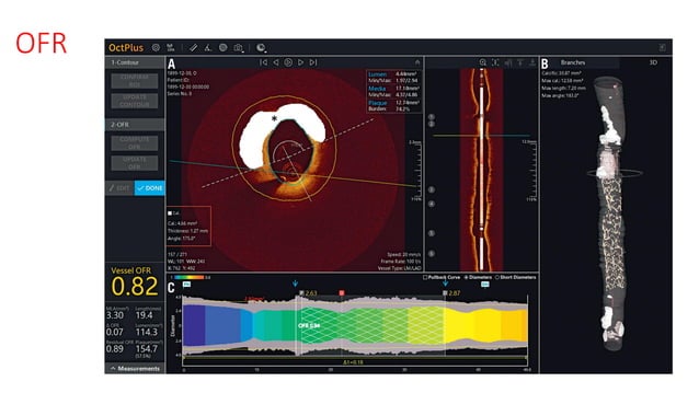 OCT in coronary PCI | PDF