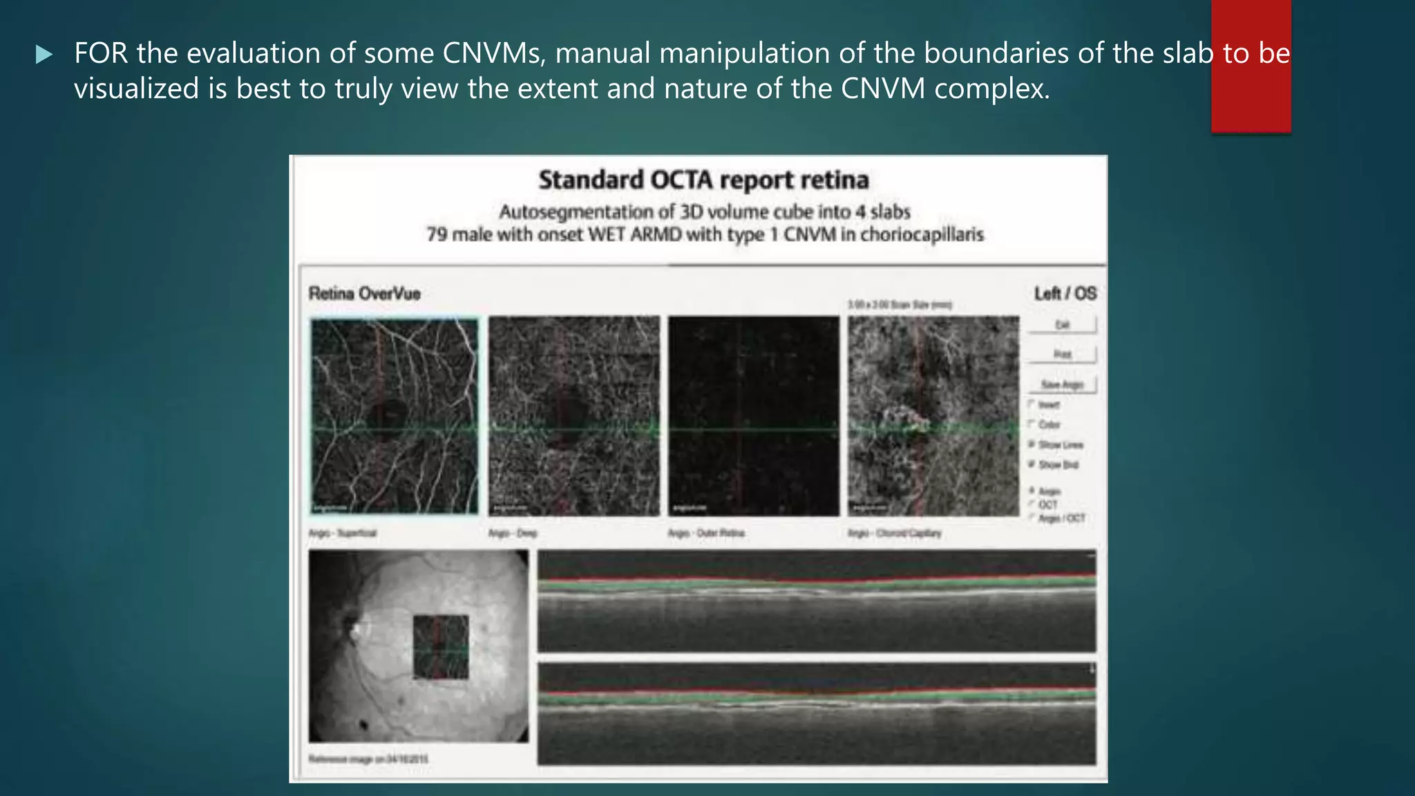 OCT Angiography | PPTX