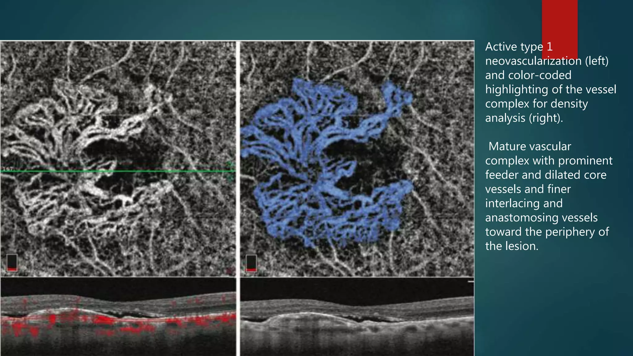 OCT Angiography | PPTX