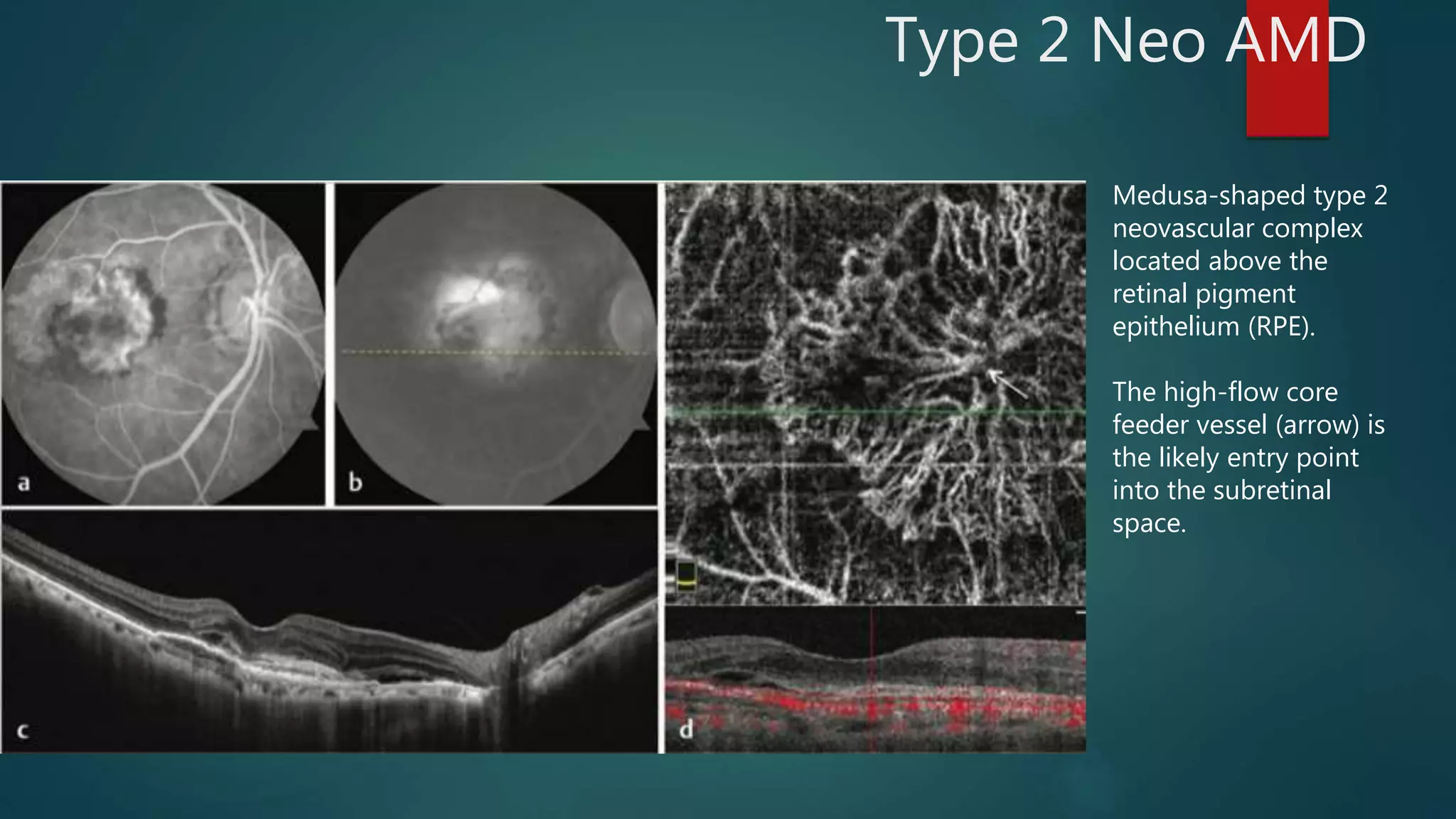 OCT Angiography | PPTX
