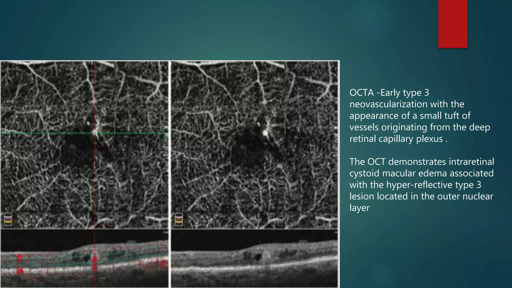 OCT Angiography | PPTX