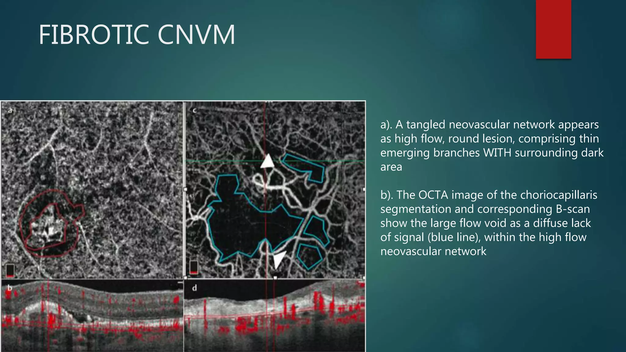 OCT Angiography | PPTX