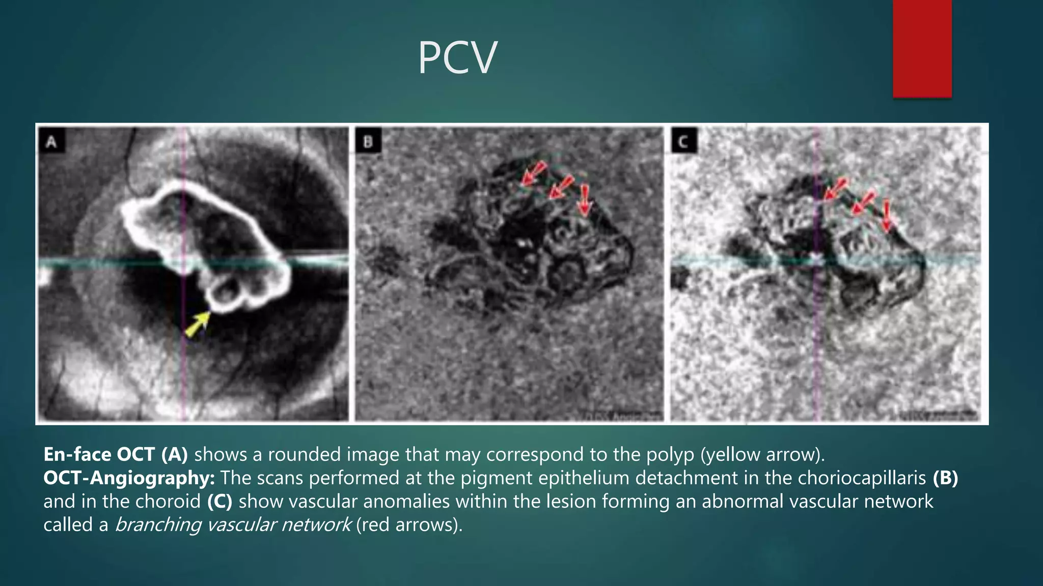 OCT Angiography | PPTX