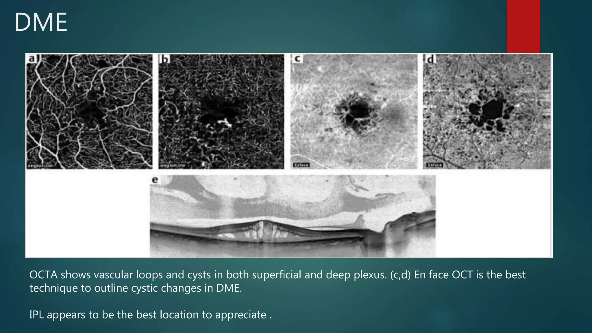OCT Angiography | PPTX